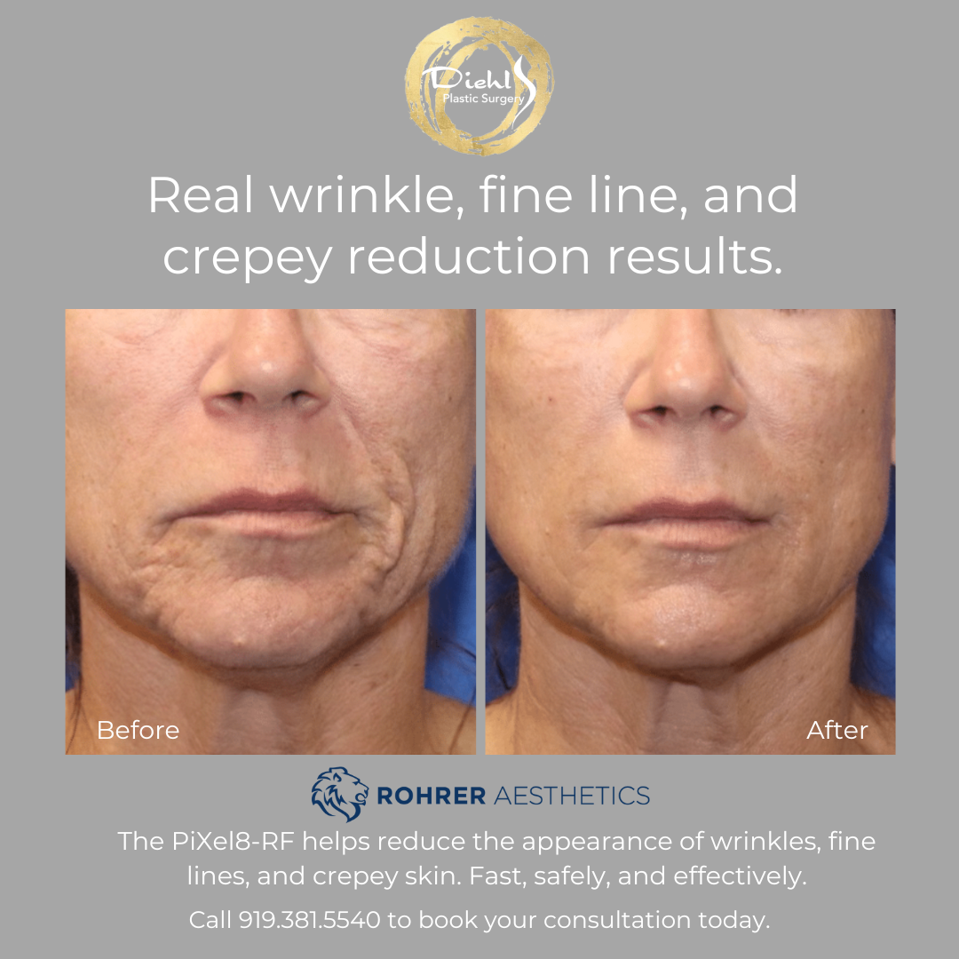 The PiXel8-RF Radio Microneedling System - Diehl Plastic Surgery